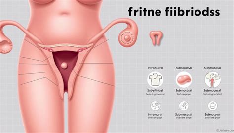 Norethindrone And Fibroid Reduction Insights And Tips