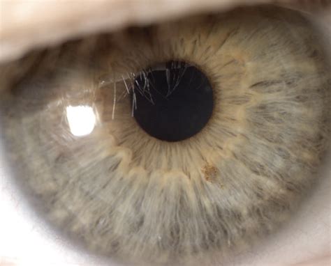 Crstoday Extreme Astigmatism In A Pre Presbyopic Patient