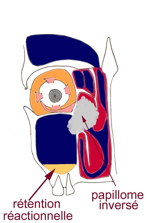 Tumeur Fosse Nasale Polype