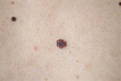Skin Cancer Types