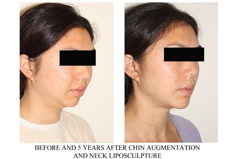 Chin Implant And Neck Liposuction