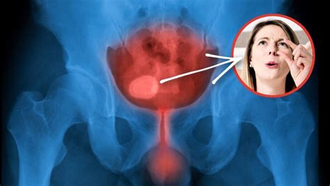 Small Male Organ Medical Leaks
