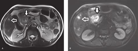 Demonstration Of Liver Metastases In Diffusion Weighted Imaging Dwi Download Scientific