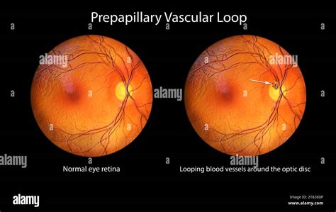 Illustration Of A Prepapillary Vascular Loop On The Retina As Observed