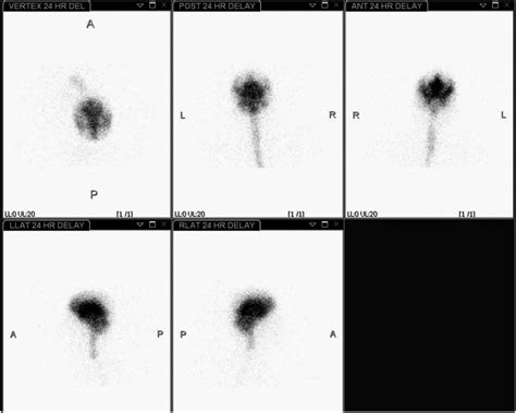 Nuclear Medicine Cisternogram Cerebrospinal Fluid Leak Imaging