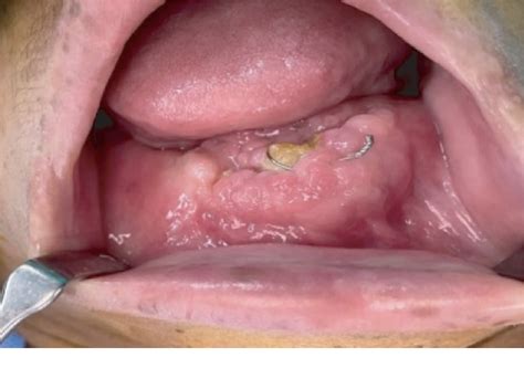 Figure 1 From Actinomycosis Osteomyelitis Of The Mandible In A 71 Year Old Patient A Case