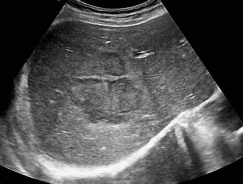 Abdomen And Retroperitoneum 11 Liver Case 119 Metastases