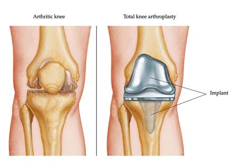 Osteoarthritis Knee Replacement