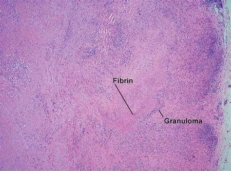 Granuloma Annulare Pathology Outlines