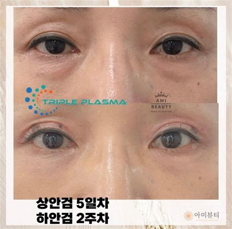 상안검 리프팅 고민되시면 플라스마블라스트 대구 아미뷰티에서 받으세요 네이버 블로그