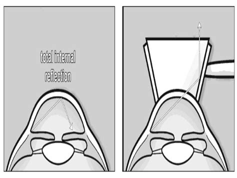 Gonioscopy