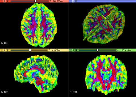 Dti教程06 弥散张量的可视化 Dti 3dslicer中文论坛