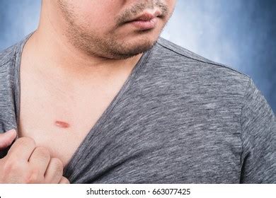 Keloid Scar Images Stock Photos Vectors Shutterstock