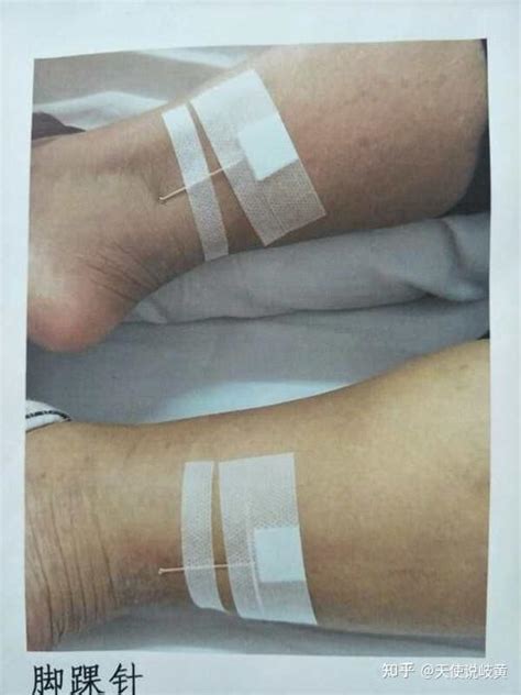 腕踝针疗法治疗周围性面瘫的临床观察 知乎