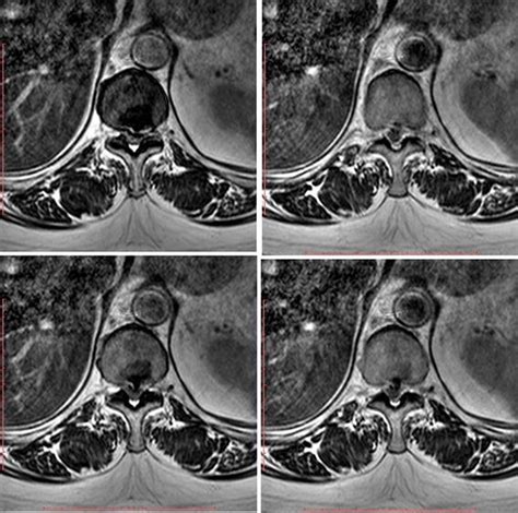 Pre Surgical Axial T2 Weighted Mri View Of The D10 D11 Intersomatic
