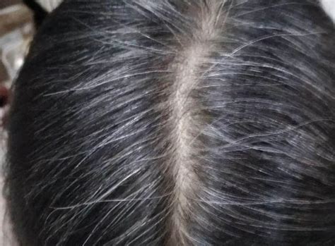 爲什麽「白髮」越長越多？你以爲是老了「可能缺乏2種營養素」 醫生：三個妙招預防白頭髮