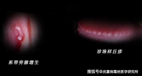 珍珠丘疹高清图片珍珠样丘疹图片珍珠丘疹症状图片大全第7页大山谷图库