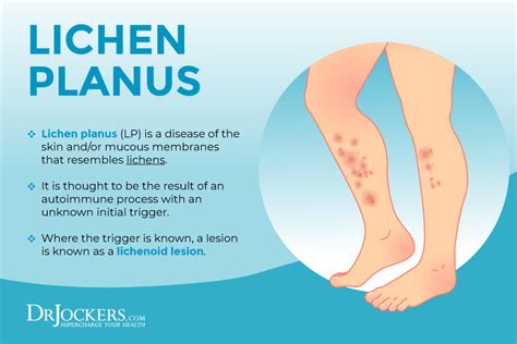 What Vitamins Help Lichen Planus At Carrie Booker Blog