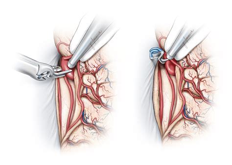 Pericallosal Artery Aneurysm The Neurosurgical Atlas
