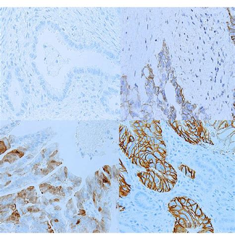 Her2 Positivity In New Mexican Cases Of Gallbladder Cancer By