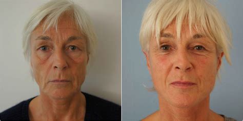Will Mini Face Lift Remove Wrinkles Top Sellers
