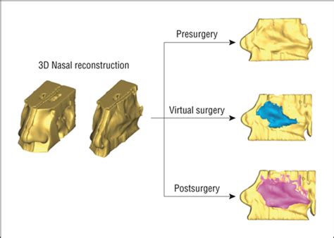 Toward Personalized Nasal Surgery Using Computational Fluid Dynamics Jama Facial Plastic