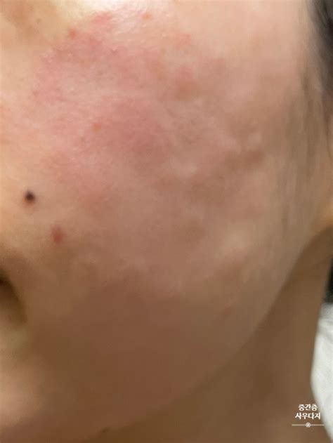 강남 엑셀브이레이저 1회차 후기 효과 붓기 부작용 네이버 블로그