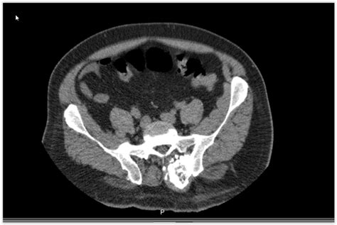 Sacral Chondrosarcoma Oncosurgery