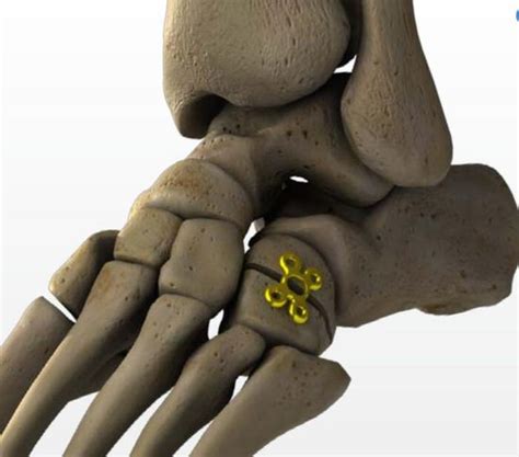 China Surgical Instrument Hollow Tibial Osteotomy Plate China Ankle Product Hollow