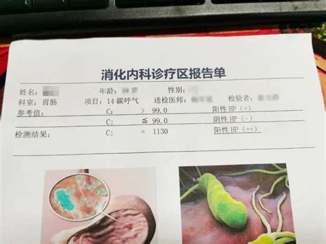 合卫顺体检发现幽门螺杆菌不是所有阳性都一定要清除 合卫顺官网