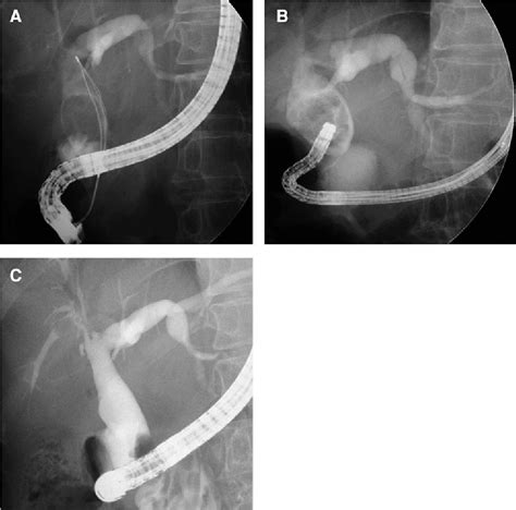 Figure 1 From Direct Cholangioscopy Based Holmium Laser Lithotripsy Of Difficult Bile Duct