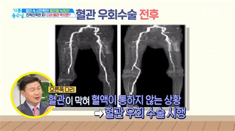 다리를 썩게 하는 혈전 경고 증상