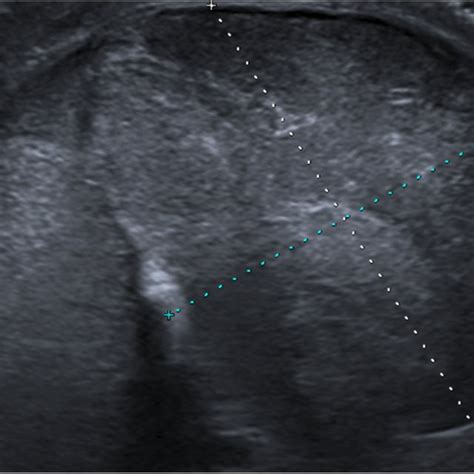 Overview Of Case Reports On Idiopathic Spontaneous Scrotal Hematomas