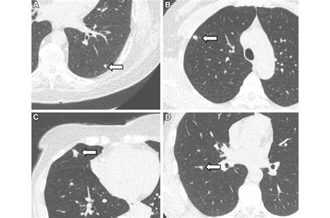 Lung Nodules Seen In A High Percentage Of Non Smokers Healthmedicinet
