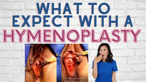 What To Expect With A Hymenoplasty YouTube