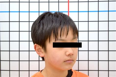＜症例紹介1＞スペース不足・ガタガタの歯並び 西京区のさわだ矯正歯科桂クリニック