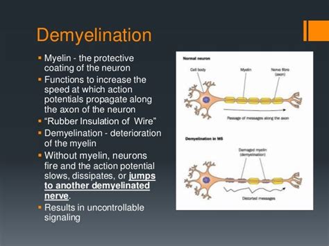 Trigeminal Neuralgia