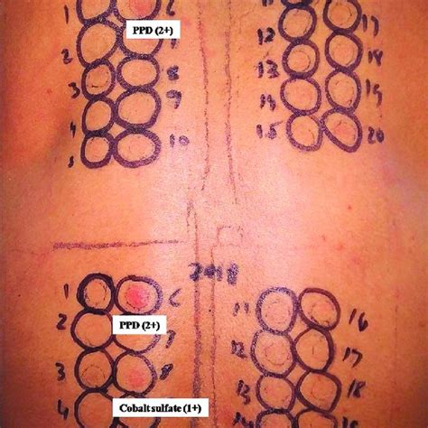 Group 2 Patch Test Results With Indian Standard Patch Test Series With