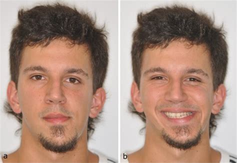 Asymmetrical Face Causes