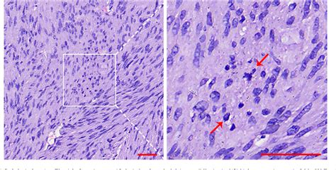 Figure 4 From A Rare Rectal Gastrointestinal Stromal Tumor With Indolent Biological Behavior A