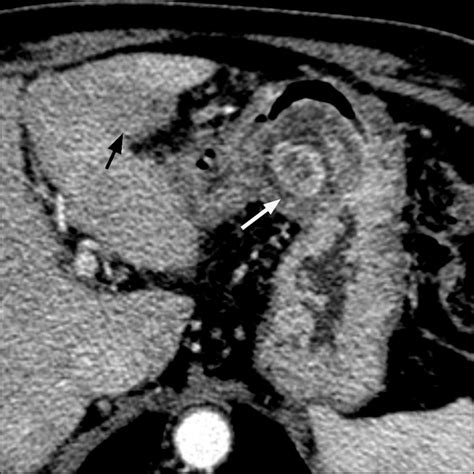 Contrast Enhanced Computed Tomography Scan Showing An Heterogeneous