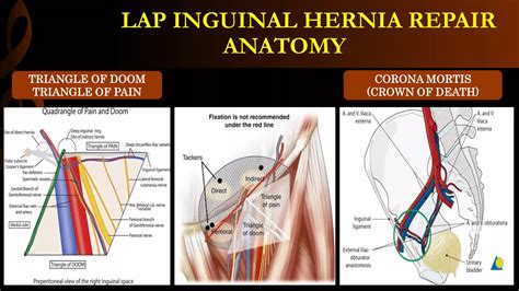 Lap Inguinal Hernia Repair Operative Surgery Pptx