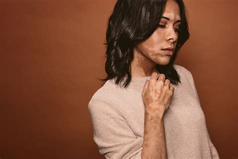 Vitiligo Surgery Astral Skin World