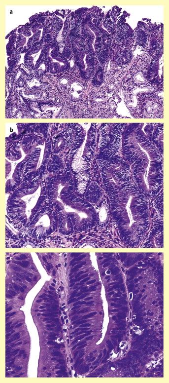 Gastric Dysplasia Update And Practical Approach Diagnostic
