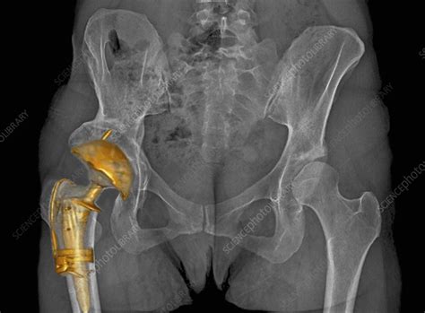 Hip Replacement 3d Ct Scan Stock Image C0212000 Science Photo