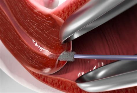 Self Sampling Hpv Test Set To Eliminate Cervical Cancer In Malaysia Healthcare Today