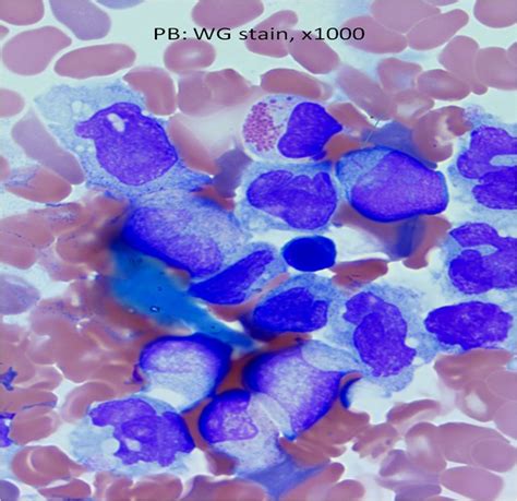 Test 1 Hematopathology