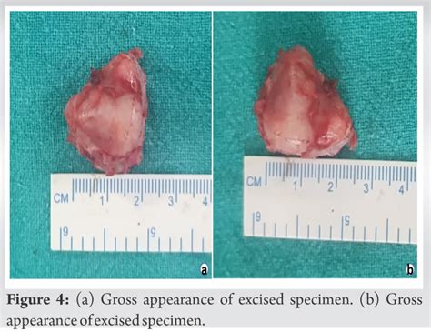 Osteochondroma Dorsal Scapula Rare Site Of A Common Tumor Journal