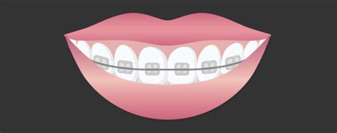 Clear Aligner Dental Treatment In Korea Gangnam Gentle Dental Clinic In South Korea