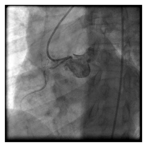 The Difficulty In Aligning Catheters With The Anomalous Right Coronary